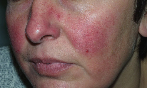 Erythro_couperose – Centre Laser Dermatologique Lyon